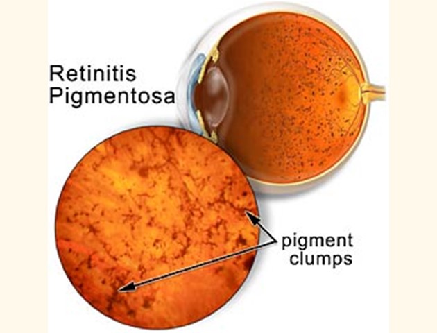 Retinitis Pigmentosa Before And After