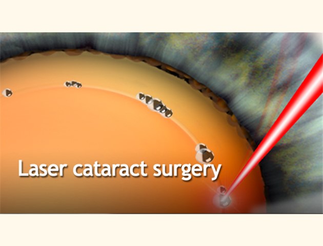 Femtolaser cataract