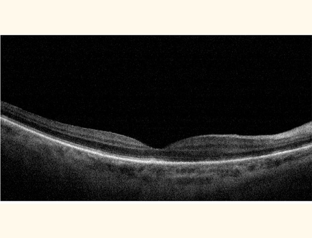 Oct- retina examination without injection