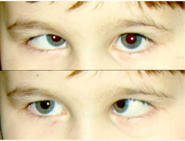 Strabisme - scheelzien