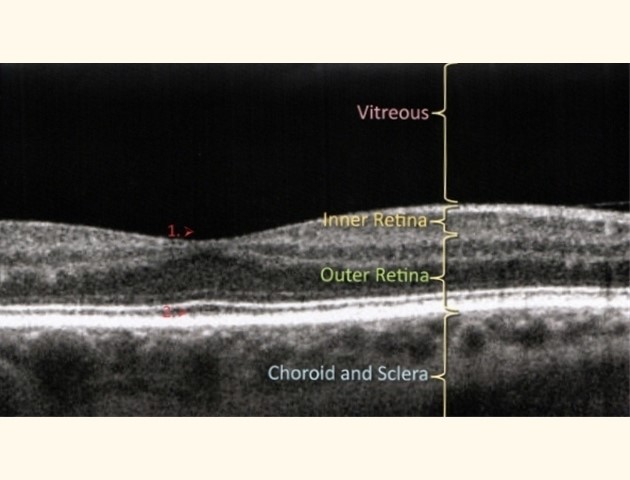 Oct- retina examination without injection